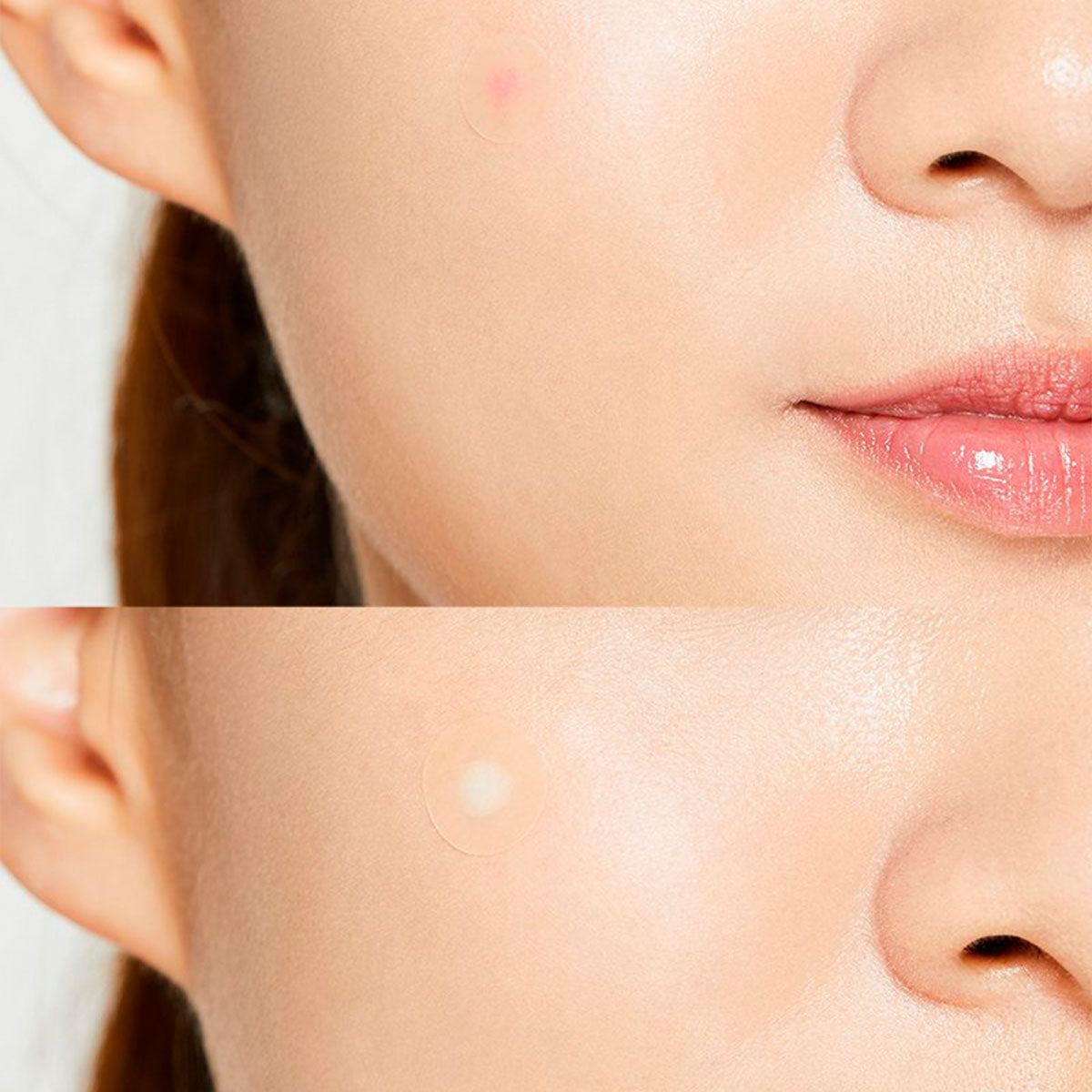 Acne Pimple Master 24 Patches | Skin & Tonic